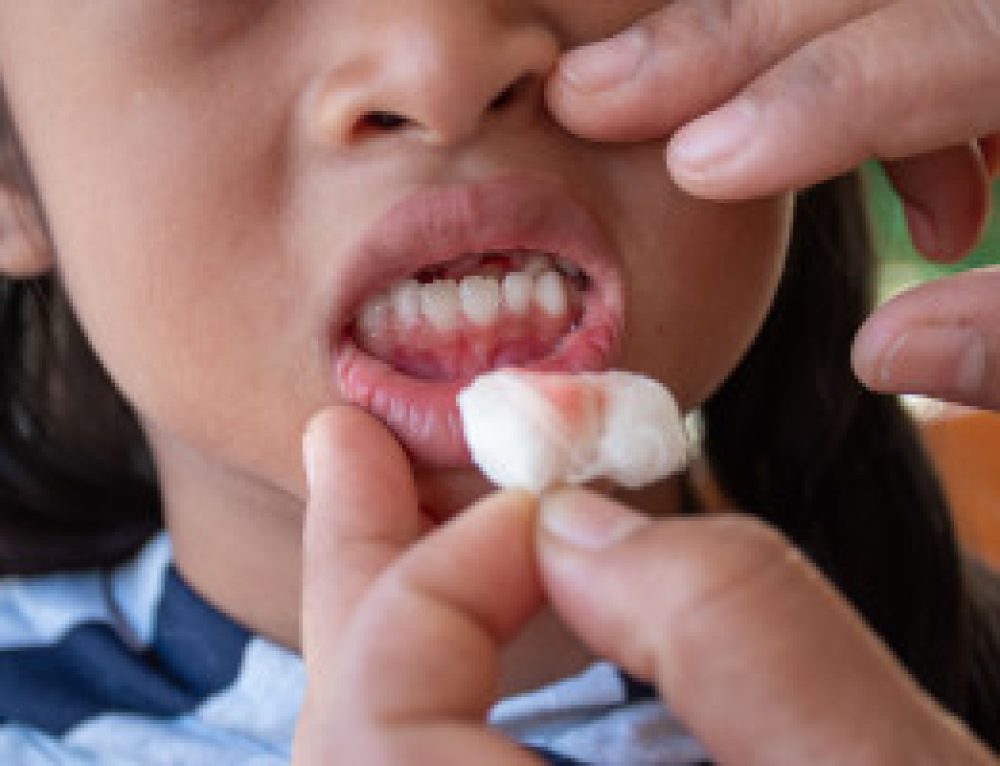 4 Types of Pediatric Dental Bridges That Can Save Your Kids Smile