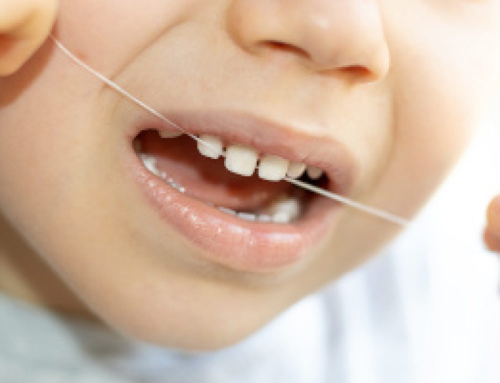 4 Types of Pediatric Dental Bridges That Can Save Your Kids Smile