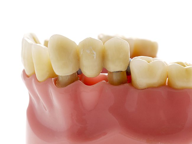 7 Signs Your Child Is a Good Candidate for a Dental Implant